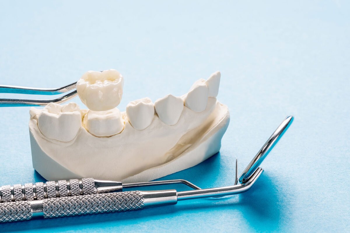 Dental Crowns | Tooth Crown | Somerset Dental On James