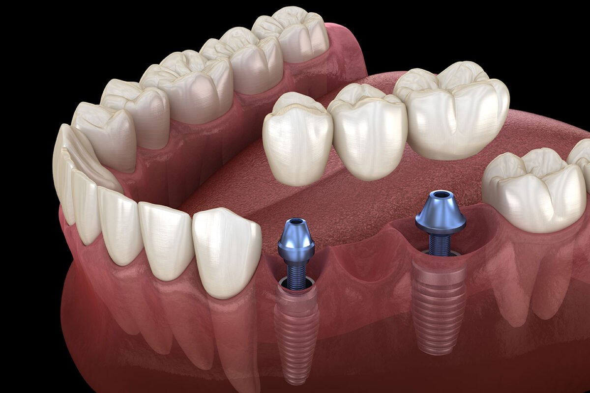 Dental Implant vs Bridge: What’s Right for You? | Somerset Dental